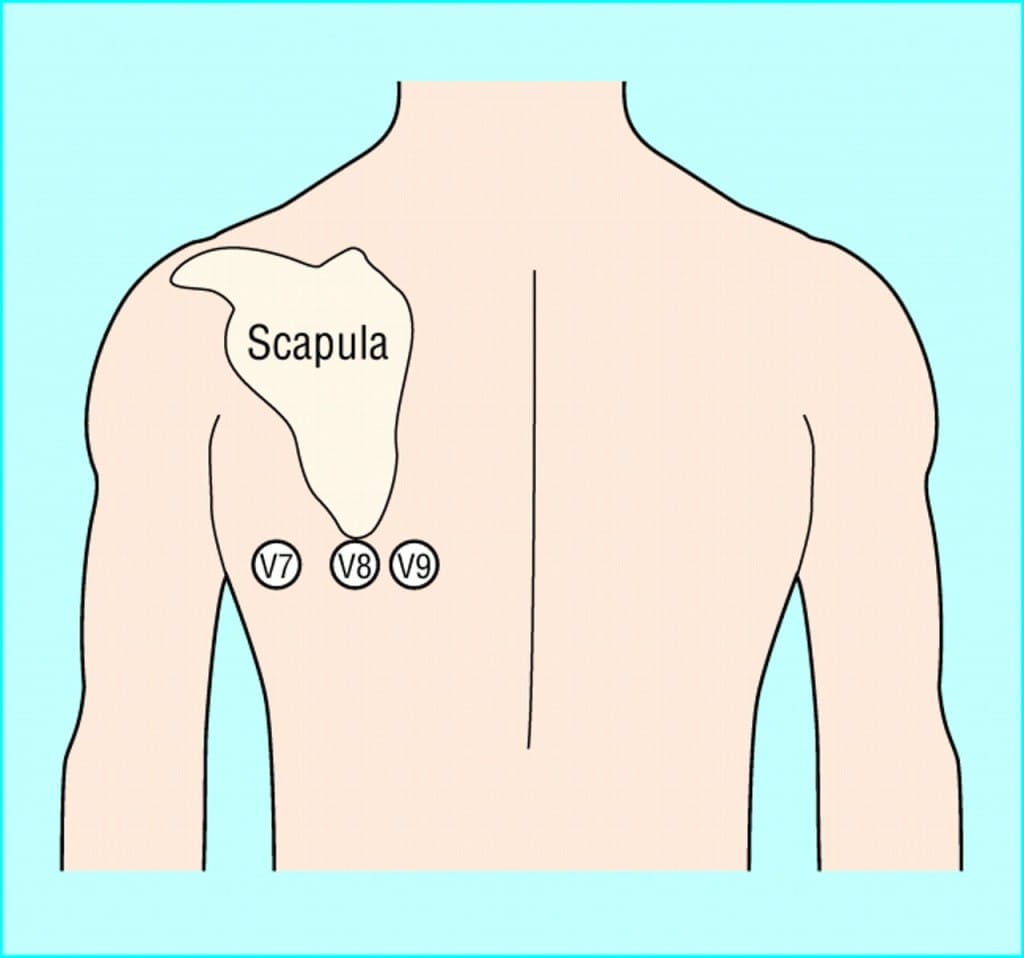 Ekg Placement Mastering 12 Lead ECG Placement